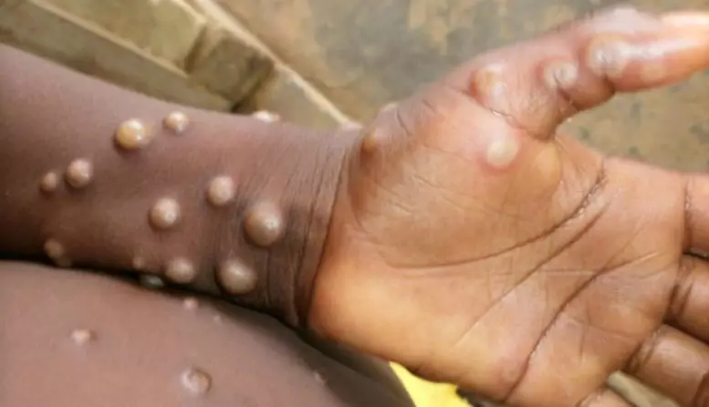 Ingcaphephe yeSifo esosulelayo: Yintoni ekufuneka uyazi malunga nokuqhambuka okutsha kweMonkeypox 1008_3