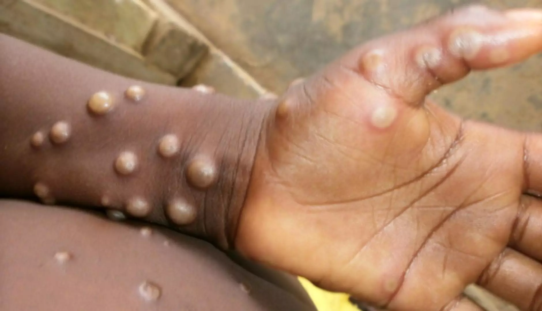 Naon Dupi Monkeypox? Ahli Mikrobiologi Ngajelaskeun Naon Anu Dipikanyaho Ngeunaan Panyakit Ieu