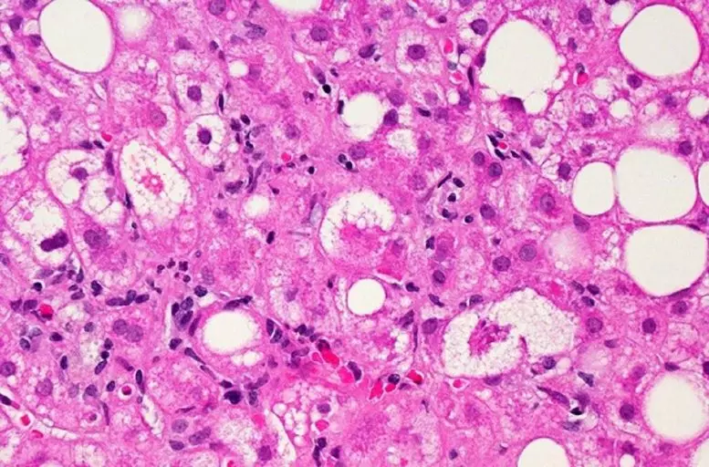 I-Liver Tissue echatshazelwa siSifo seSibindi esingenaTywala