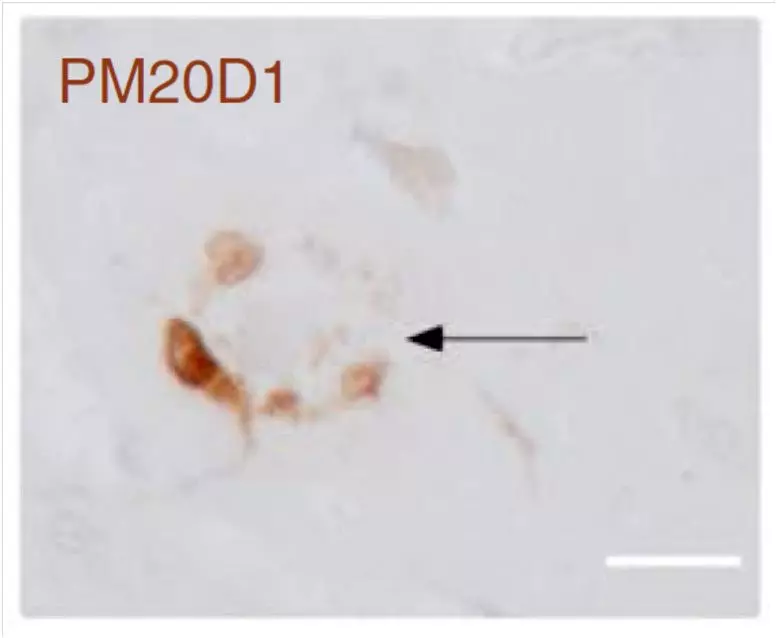 PM20D1-geenin vaihtelu, joka liittyy lisääntyneeseen Alzheimerin riskiin 11851_1