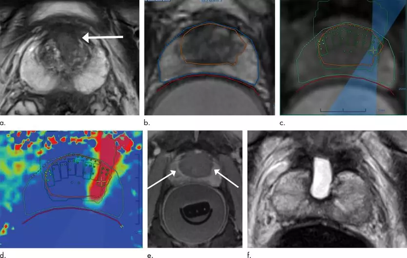 Ultraschall behandelt Prostatakrebs