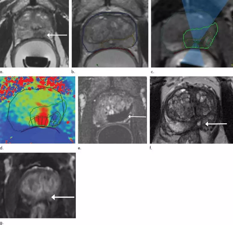 Usoro Ultrasound na-agwọ ọrịa cancer prostate