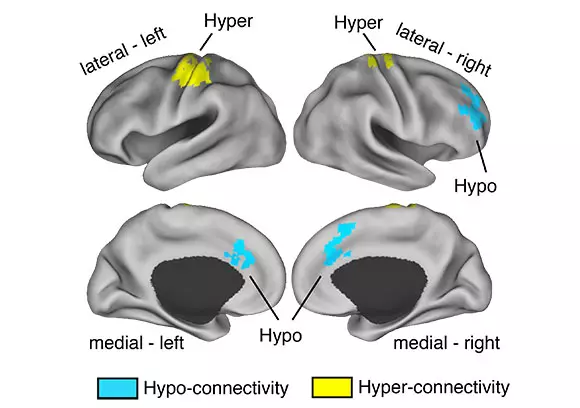 Nei Etude weist datt Gehirabnormalitéite präsent sinn och virum Ufank vu Schizophrenie