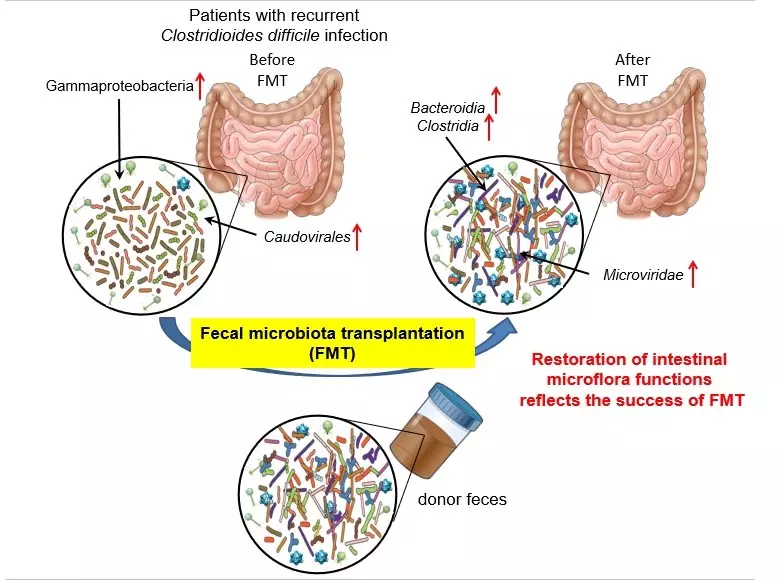 Ịmepụta Ọrụ ebube: Usoro na-aga nke ọma n'azụ Mgbanwe Fecal Microbiota ekpughere