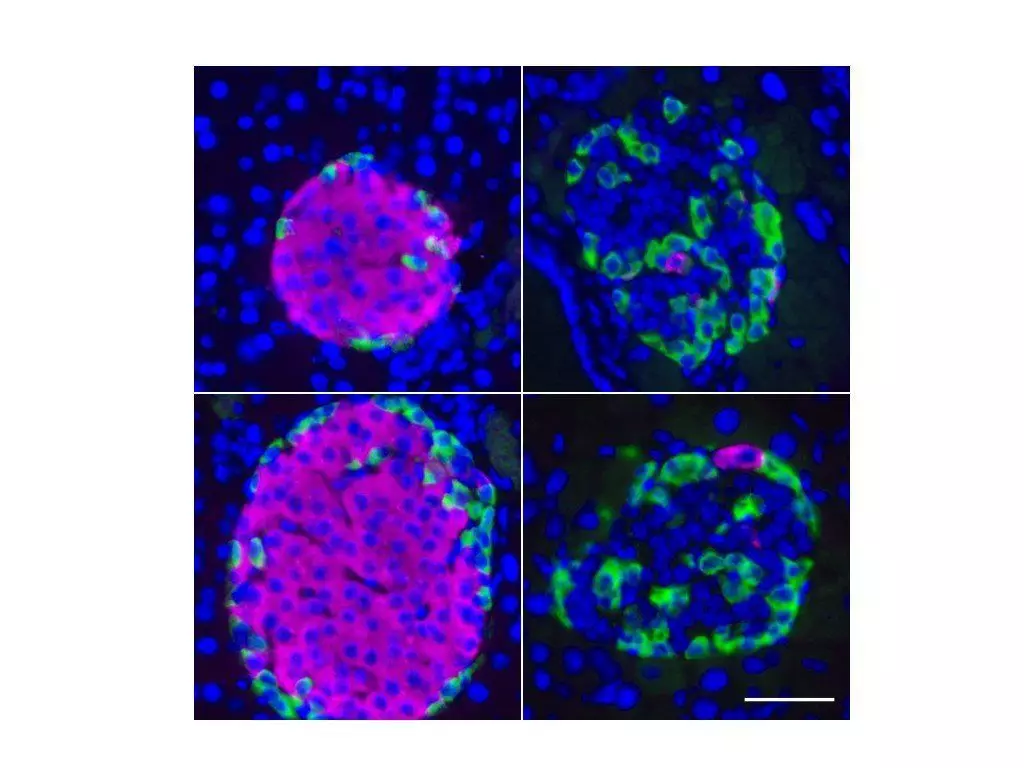 Diabetaj Rezultoj de Malfunkcio de Epigenetika Kontrolo