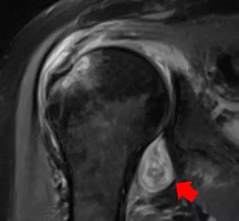 MRI នៃ Shoulder Post COVID