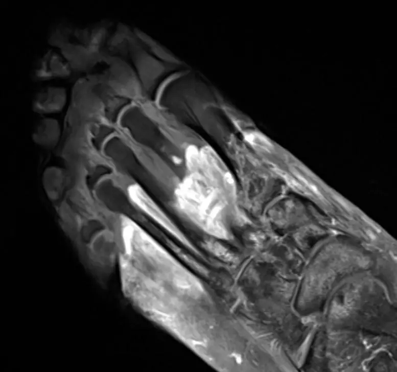 MRI នៃ Foot Post COVID