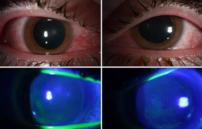 Izibani zeGermicidal Zingase Zilimaze I-Corneas