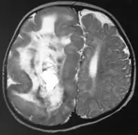 從頭體細胞突變可能導致半巨腦畸形