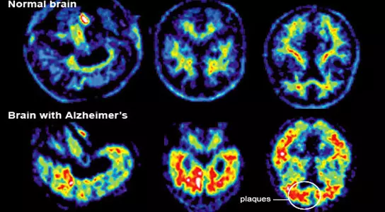 Endurforritaðar frumur benda til leiðar í átt að snemma greiningu Alzheimers 1539_1