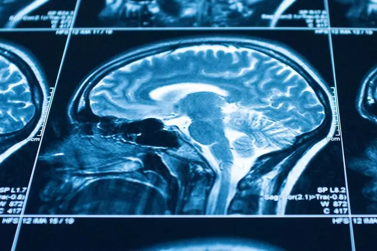 MRI Pemindaian Otak