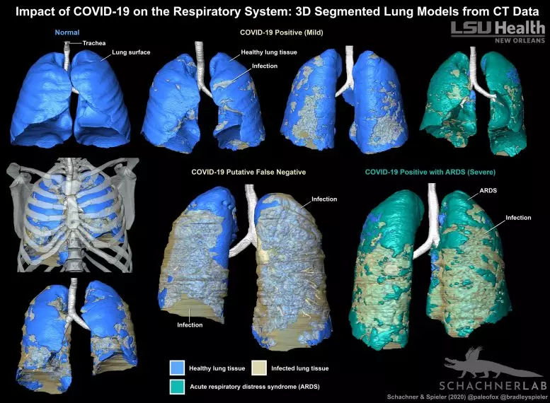 COVID-19 3D segmentované modely plic