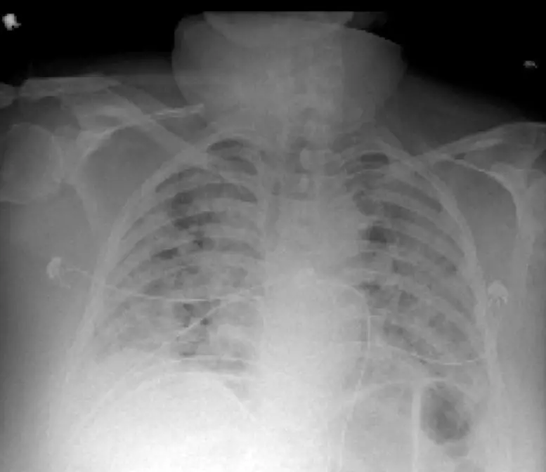 Röntgen hrudníka pacienta s COVID-19