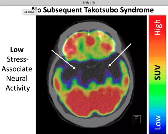 Brain Scan TTS නැත