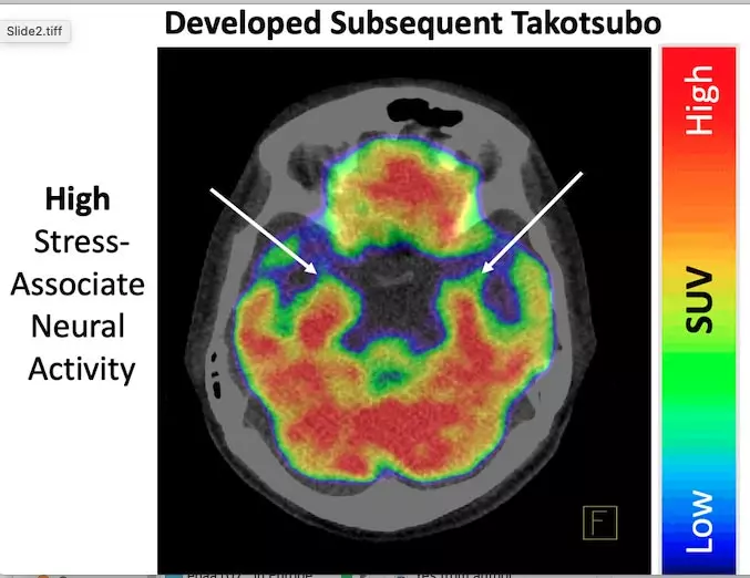 Exploración cerebral TTS