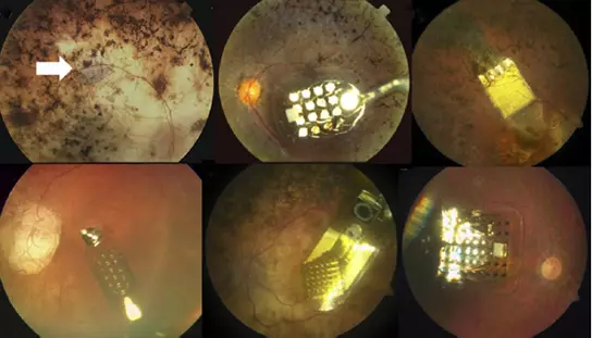 Протези сітківки ока експериментально здатні відновити зір у мишей 2263_2
