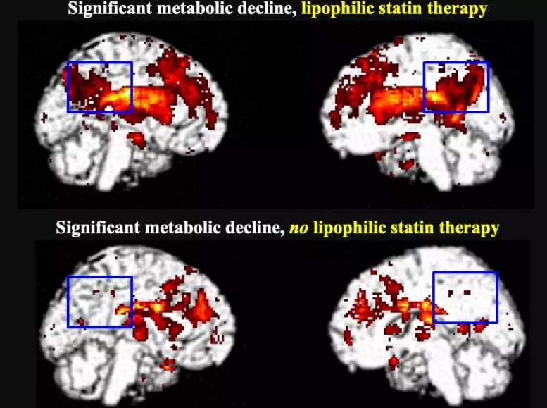 Znaczny spadek metabolizmu Statyny lipofilowe