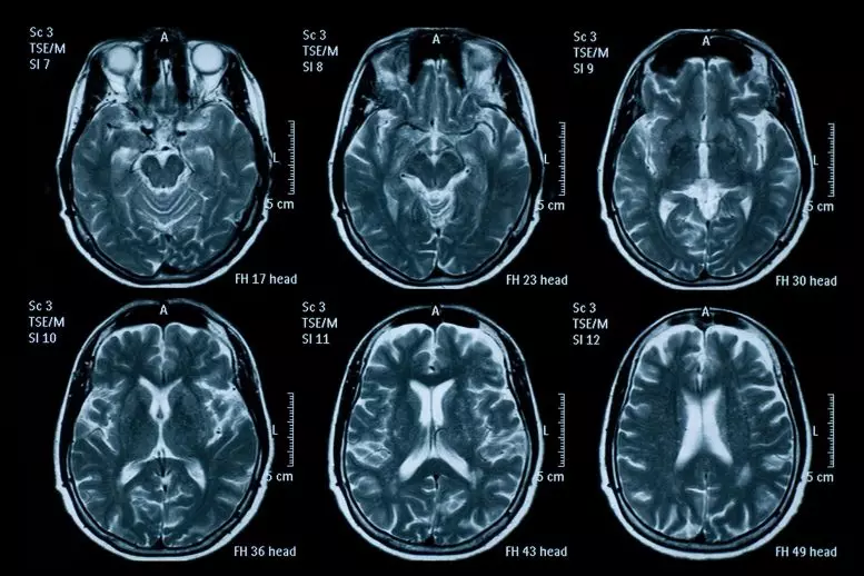 MRI బ్రెయిన్ స్కాన్లు