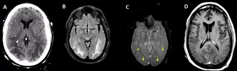 COVID-19 hjerneskanning Cerebralt ødem