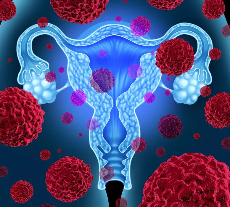 Konsepto ng Uterine Endometrial Cancer Therapy