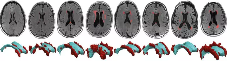 La pressione meccanica del liquido cerebrospinale pulsante porta a lesioni cerebrali