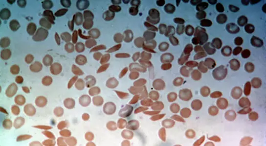 i-microfluidic device engahlaziya ukuziphatha kwamasampula egazi ezigulini ze-sickle cell disease