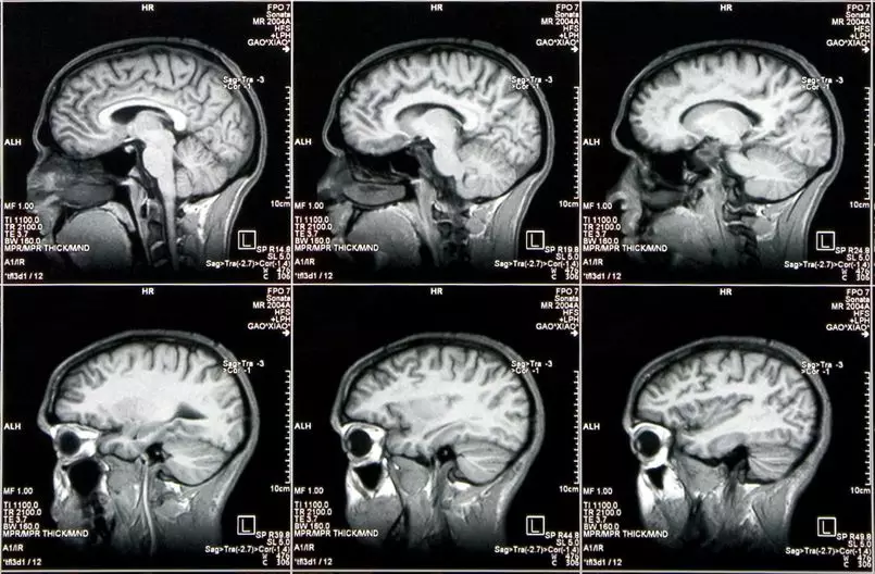 Várias imagens cerebrais de tomografia computadorizada