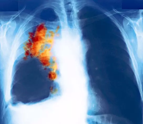 Makakatulong ang Pag-cataloging sa Mga Pag-aaral ng Lung Cancer na Palakasin ang Epektibidad ng Mga Target na Therapies 3277_2