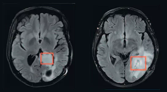A espectroscopia de RM axuda a medir a mutación do tumor cerebral