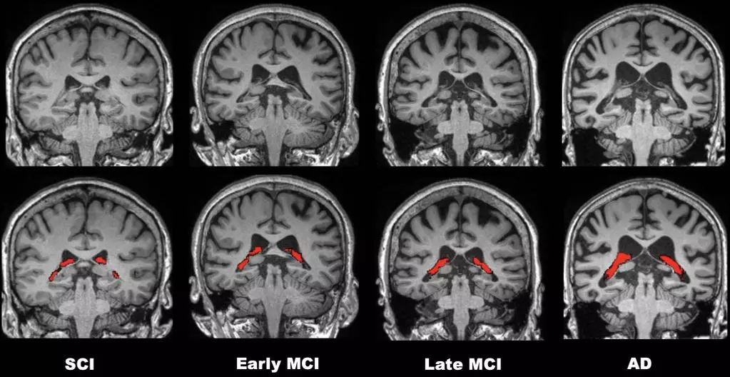 Choroid Plexus Volume Txuas rau Alzheimer's Disease