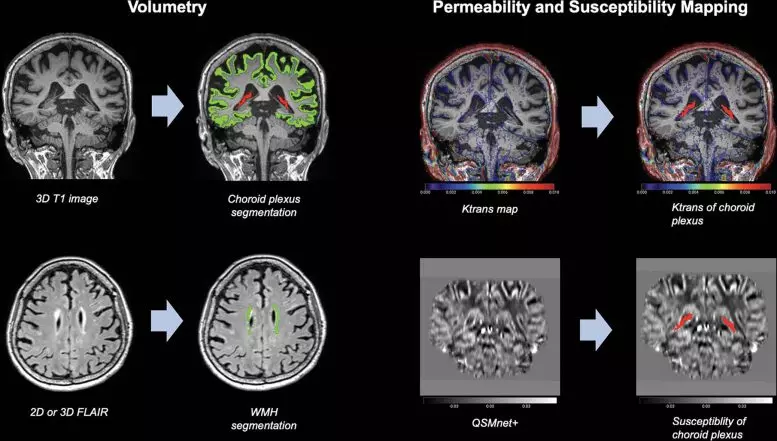 Alsgeýmeriň keseli bilen baglanyşykly MRI Horoid Plexus göwrümi