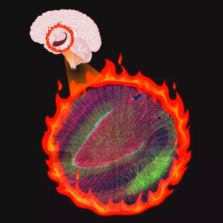 შეცვლილი უჯრედები ქმნიან ელექტრულ „ცეცხლს“ ეპილეფსიის მქონე პაციენტებში
