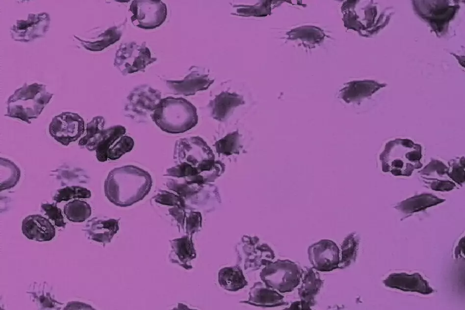 Sichelzellenadhäsion