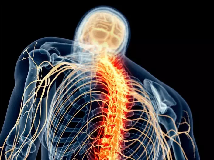 Ilustrácia bolesti miechového nervu