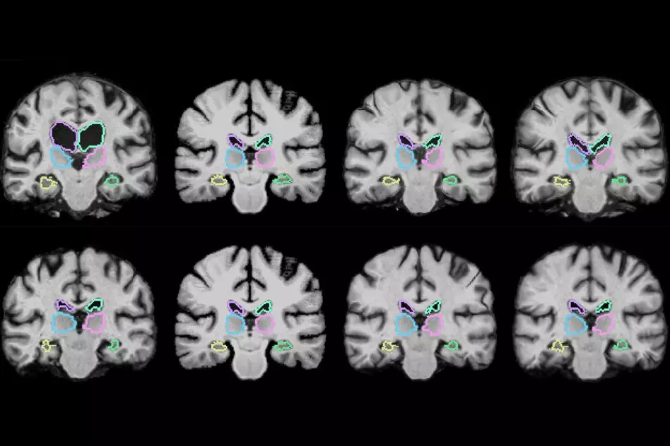 Nuovo algoritmo Analisi più rapida delle immagini mediche