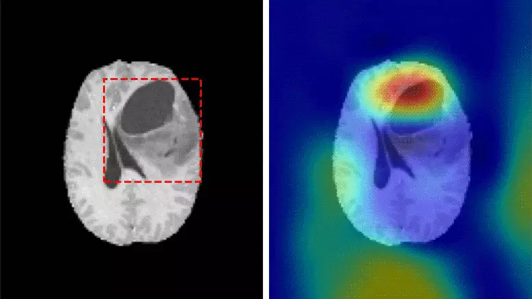 Umělá inteligence klasifikuje mozkové nádory pomocí jediného MRI skenu