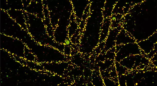 Neue nicht-invasive Methode kann Alzheimer-Krankheit frühzeitig erkennen