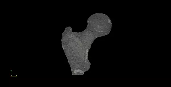 Single Pillar Femur Human