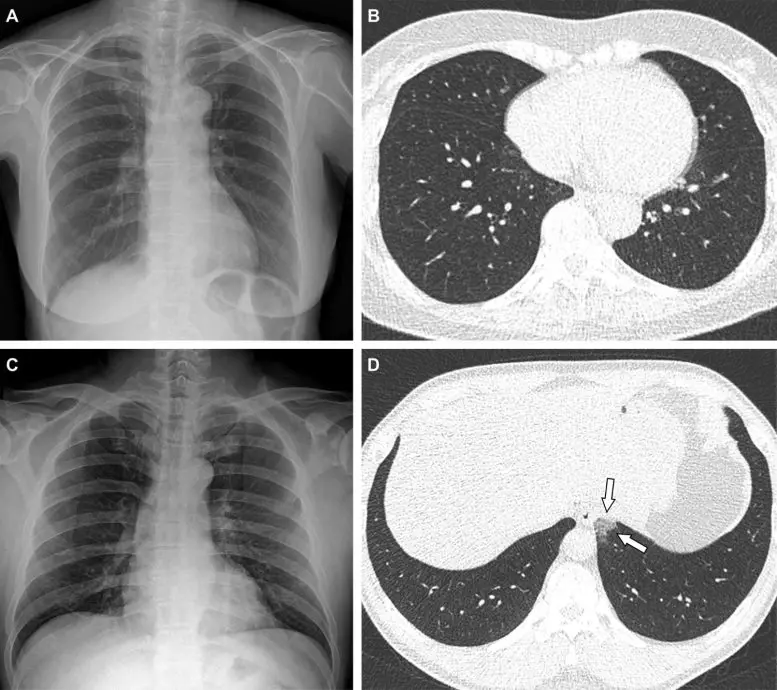 Visiškai vakcinuota nuo COVID pneumonijos