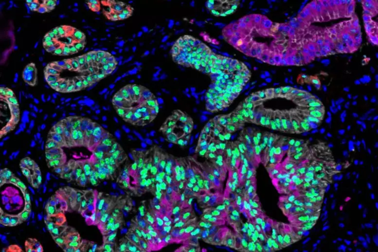 Pancreatic Cancer Tumor Cells