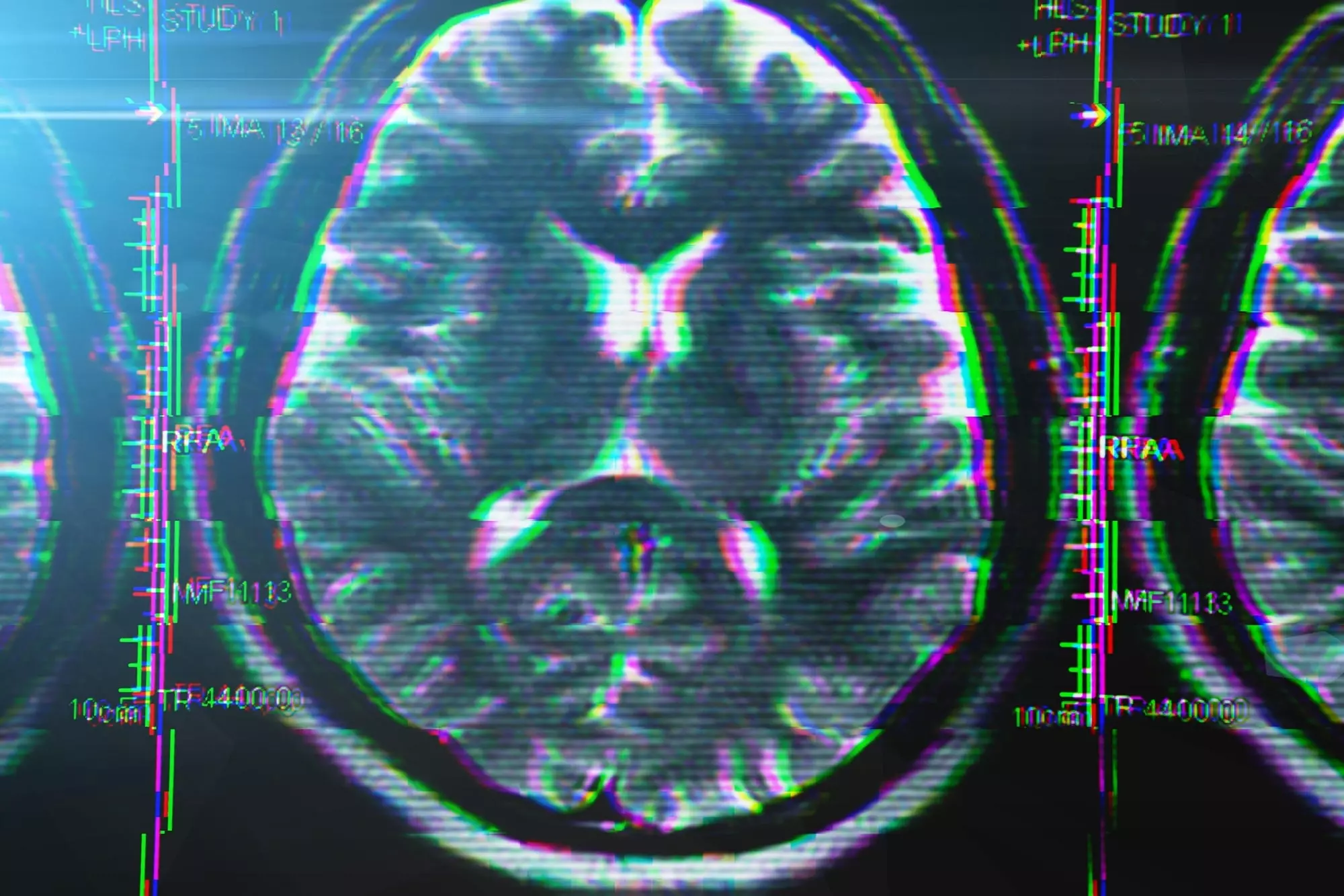 Pasien Positif COVID-19 dengan Risiko Jauh Lebih Tinggi Mengalami Gangguan Neurodegeneratif Serius