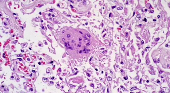 Casos de nou coronavirus anunciats per l'OMS 6852_1