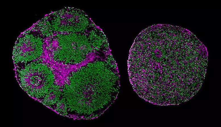 La terapia genica inverte gli effetti della mutazione legata all'autismo negli organoidi del cervello umano