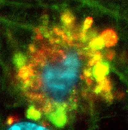 Fure-Kamar Siffofin Autophagic Vacuoles a cikin Cutar Alzheimer Babban Ƙaddamarwar Neurons