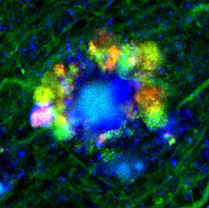 Formasi Kaya Kembang Vakuola Autofagik ing Neuron Penyakit Alzheimer Resolusi Sedheng