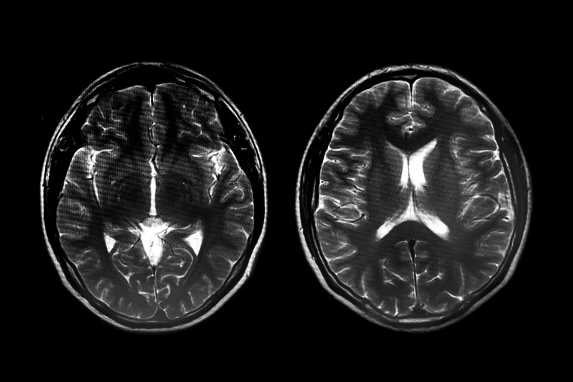 Mudanças nas áreas de processamento visual do cérebro na infância antes do diagnóstico de autismo