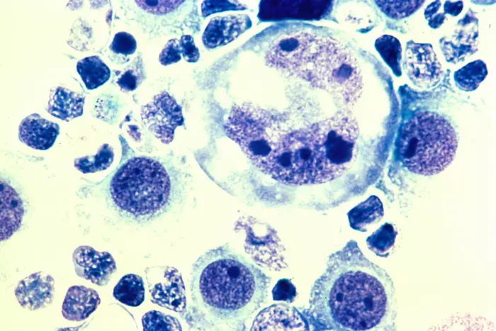 Lymfom tumorceller