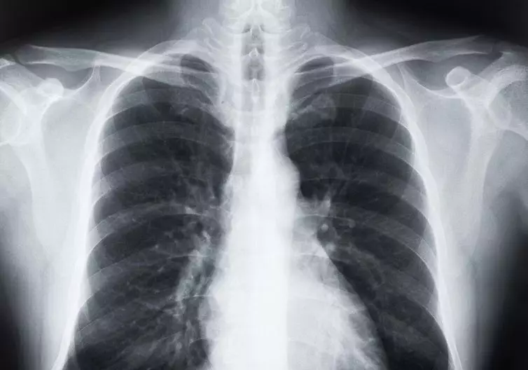 Human Chest X-ray