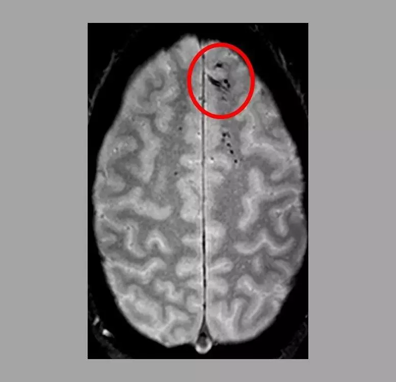 Micro-hemorragias traumáticas no cérebro